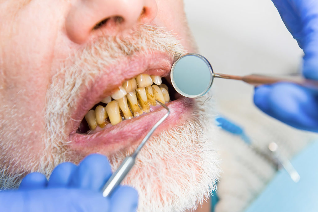 Meth Effects on Teeth | Meth Mouth Information and Treatment in California